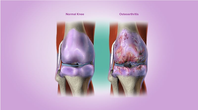 Arthrosis Classification - Bio Lexicon